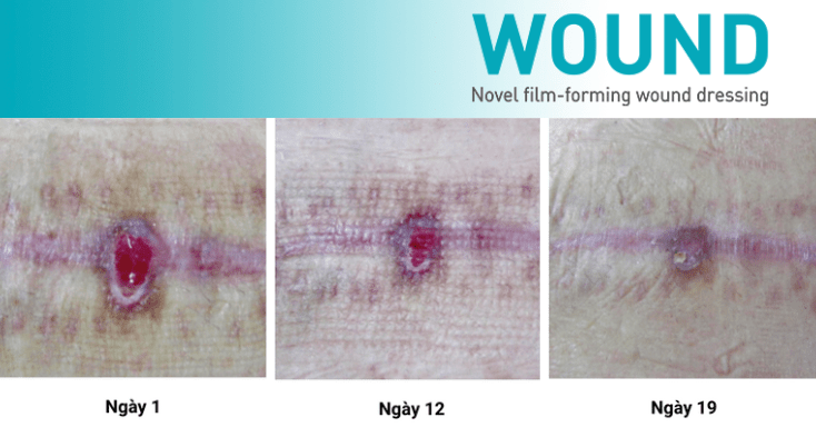 WOUND - CHUYÊN GIA NHANH LÀNH THƯƠNG VÀ GIẢM SẸO - WOUND- Xịt hỗ trợ ...